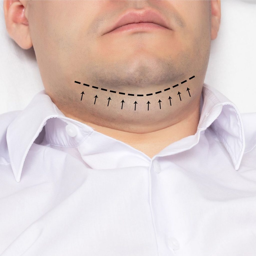 Upgrade Your Chin - Plastic Surgery in Grand Rapids, MI